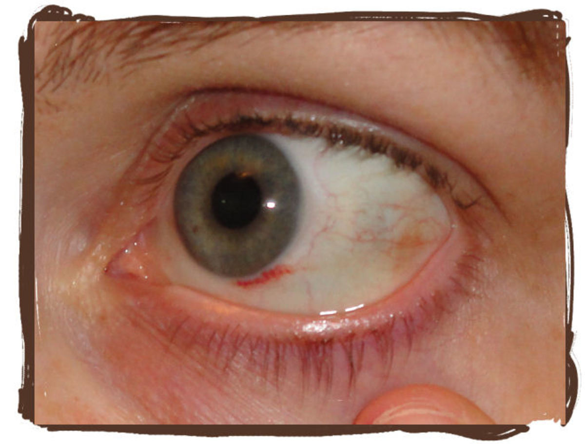 Why Did My Eye Turn Red Subconjuctival Hemorrhage Patient s Lounge why-did-my-eye-turn-red-subconjuctival-hemorrhage-patient-s-lounge