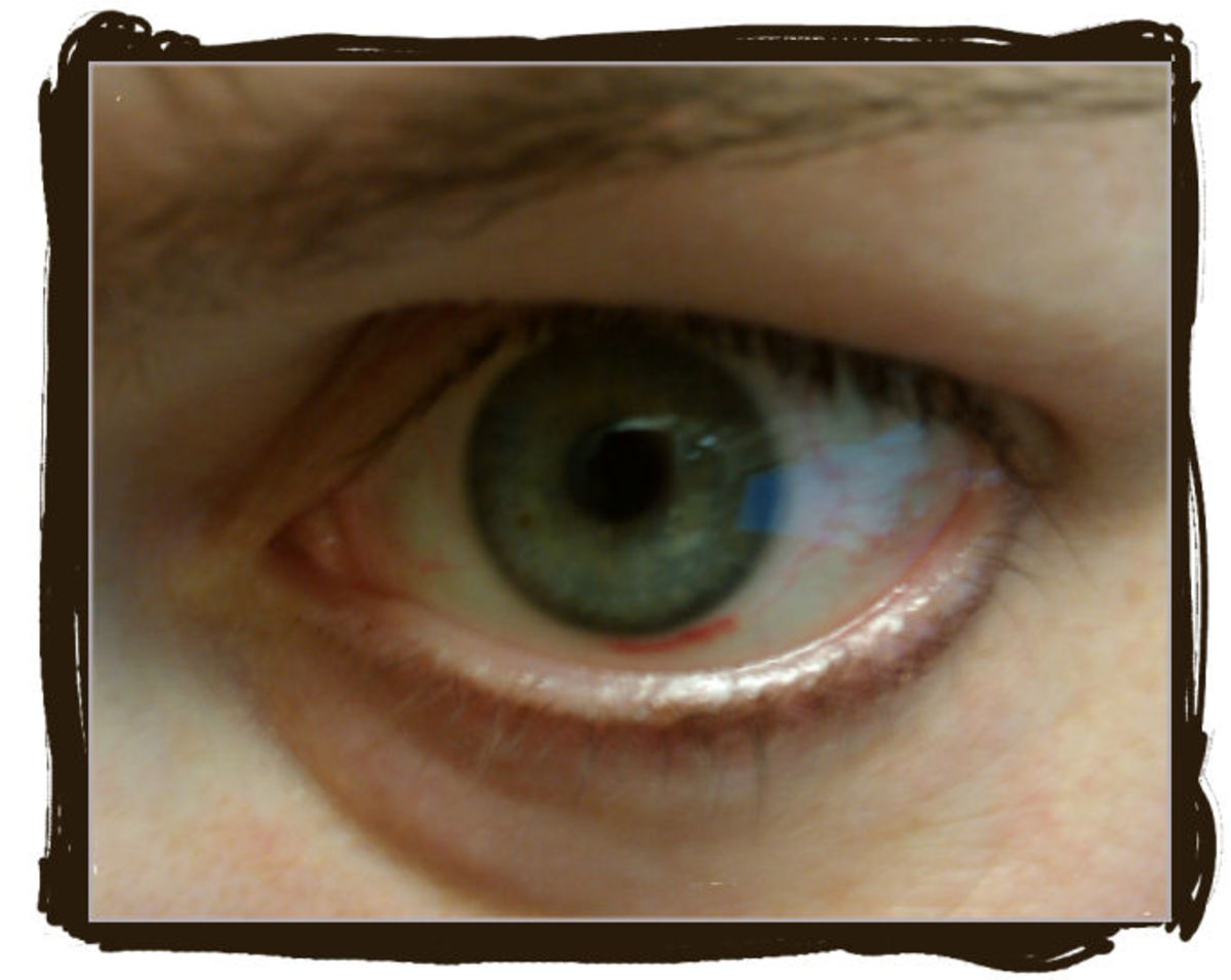 Why Did My Eye Turn Red? Subconjuctival Hemorrhage - Patient's Lounge