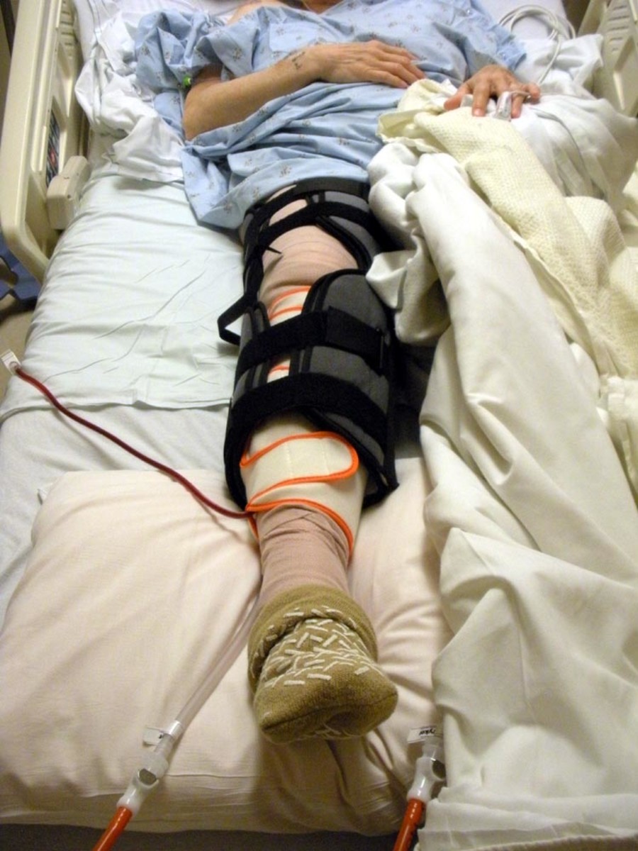 My Experience With Total Knee Replacement Surgery - HubPages