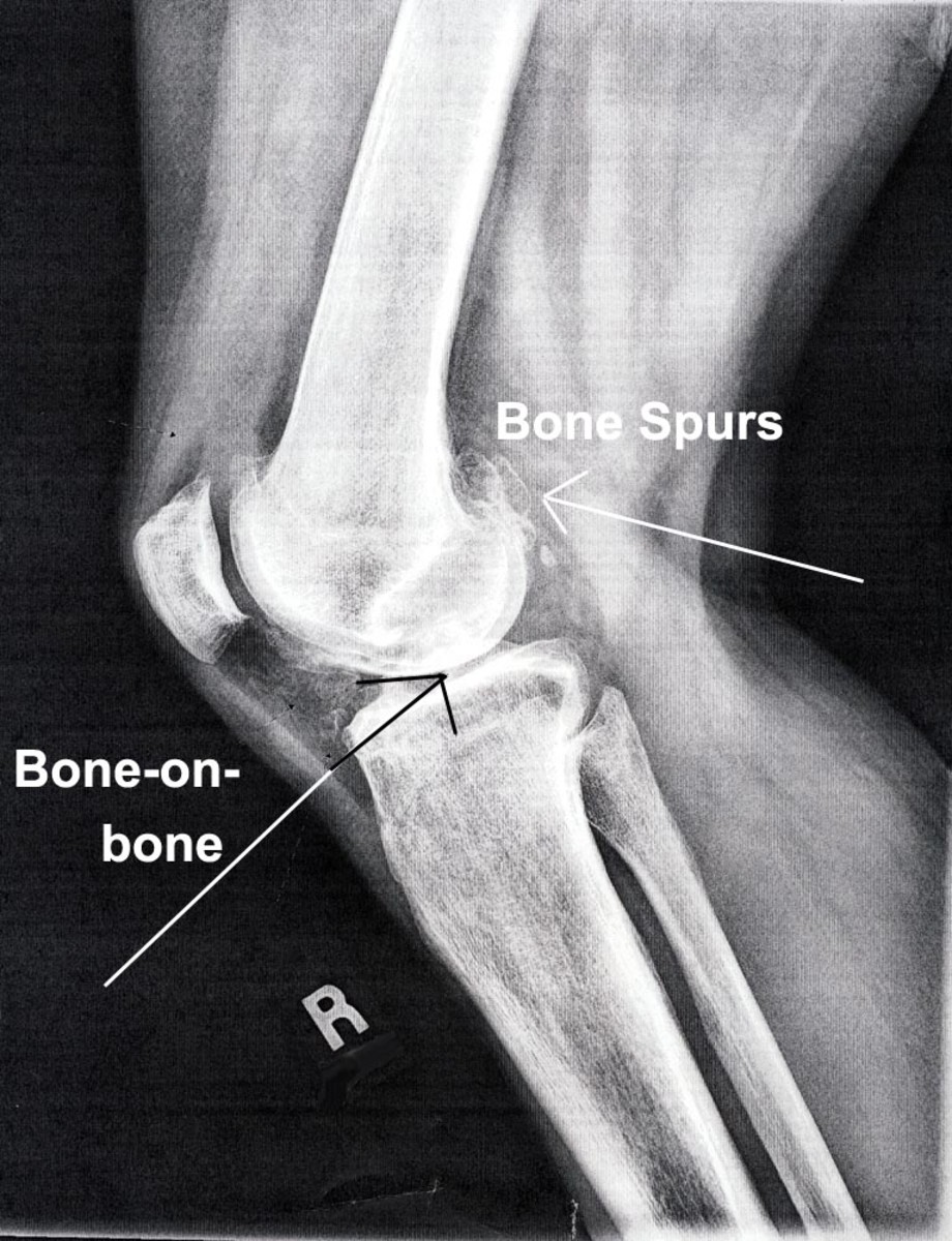 My Experience With Total Knee Replacement Surgery - HubPages