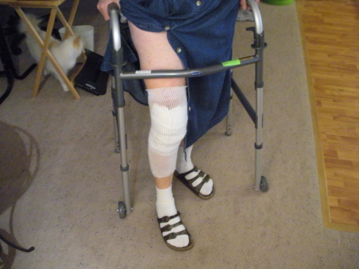 My Experience With Total Knee Replacement Surgery - HubPages