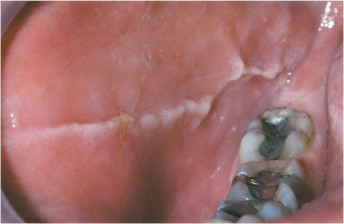 How To Check For Mouth Cancer At Home HealthProAdvice How To Check For Mouth Cancer At Home HealthProAdvice