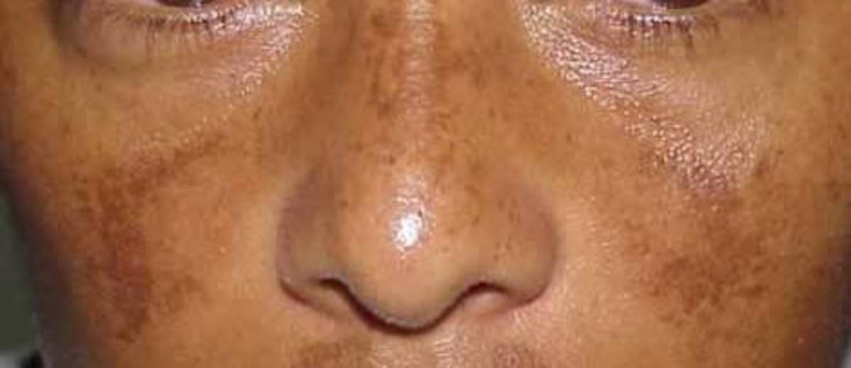 Mask Of Pregnancy Mask Of Pregnancy