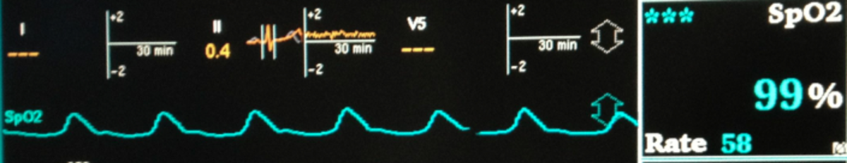 Patient Monitoring During Anesthesia - Owlcation