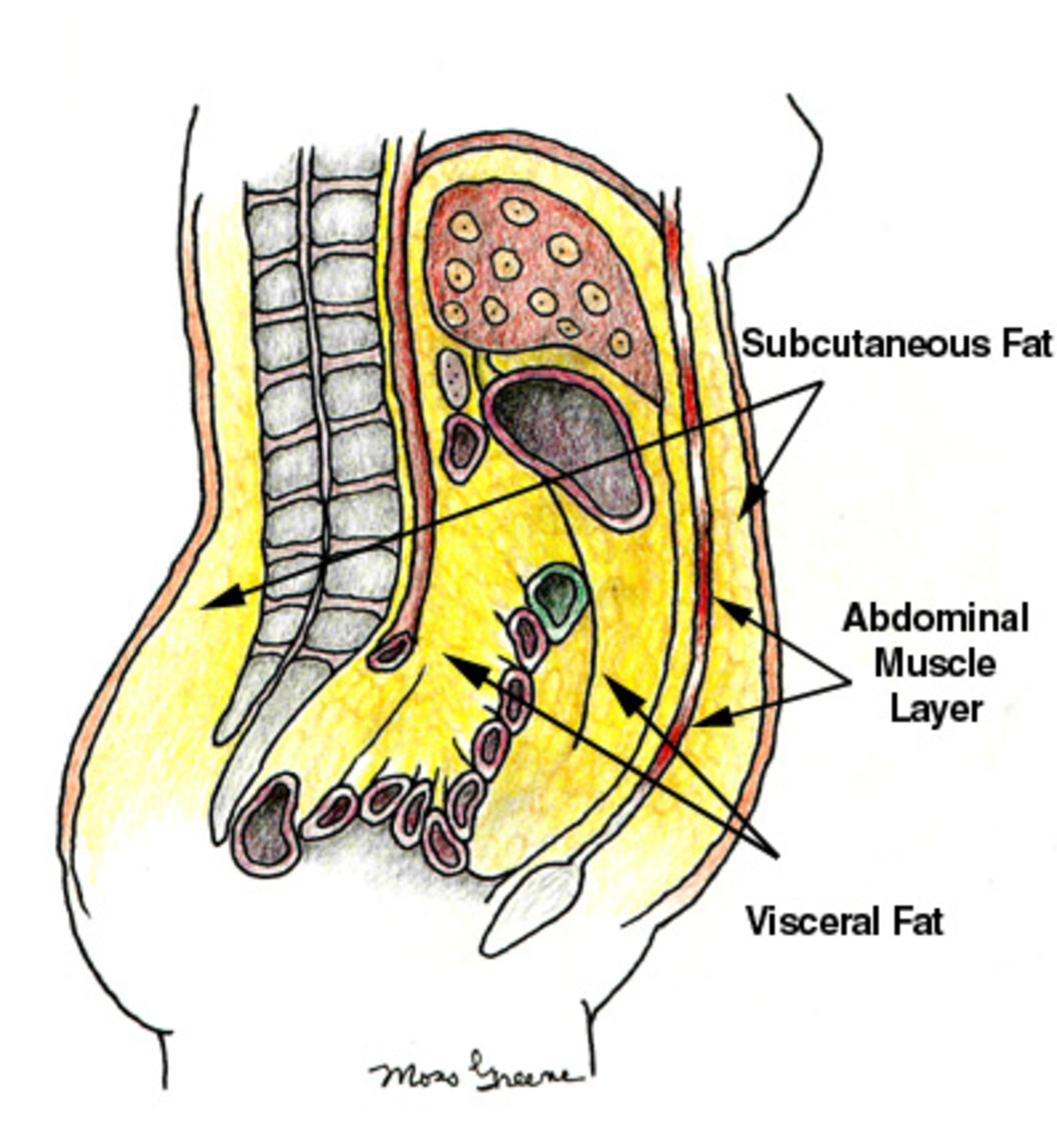 Get Rid Of Potbelly Abdominal Obesity Metabolic Syndrome CalorieBee