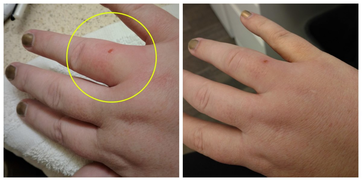 8 Photos People With Fibromyalgia Do Not Want Anyone to See - Patient's ...