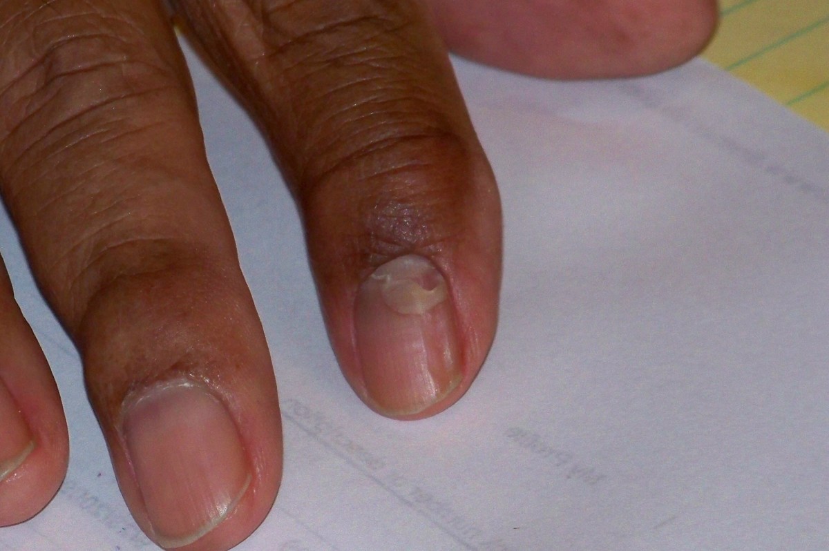 Acute gouty arthritis (Gout) and Kidney cancer surgery complications ...