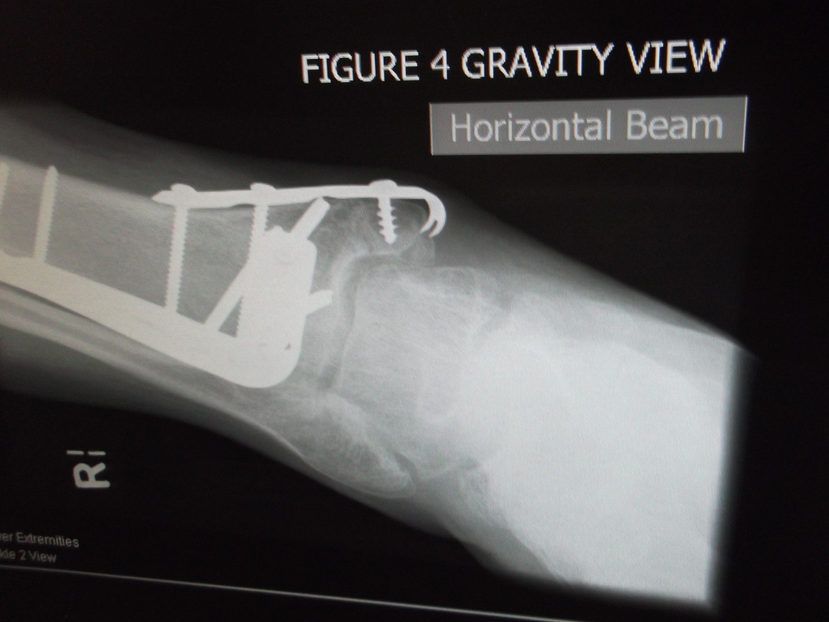 Broken Ankle Xrays With Plate and Screws - HubPages