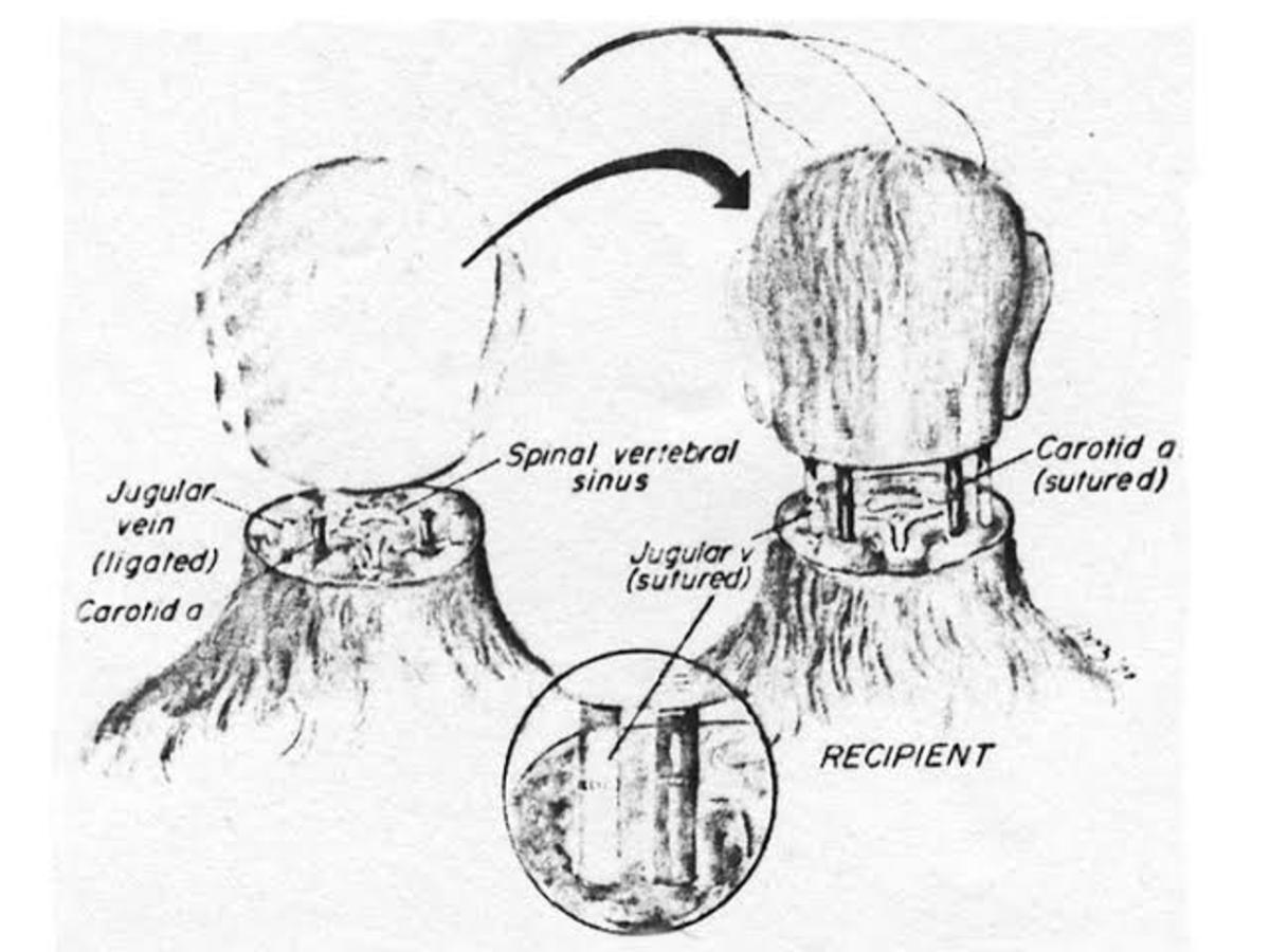 How Do You Transplant A Human Head? - HubPages
