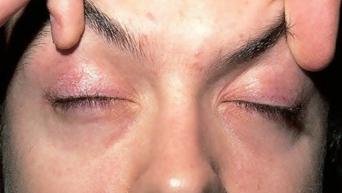 Dermatomyositis - Pictures, Symptoms, Treatment, Diagnosis, Causes ...