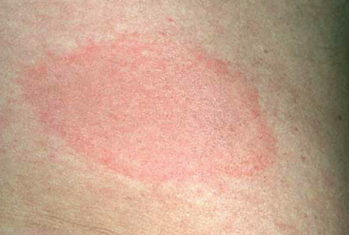 Lyme Disease: Rash Pictures, Test, Symptoms, Causes, Treatment - HubPages