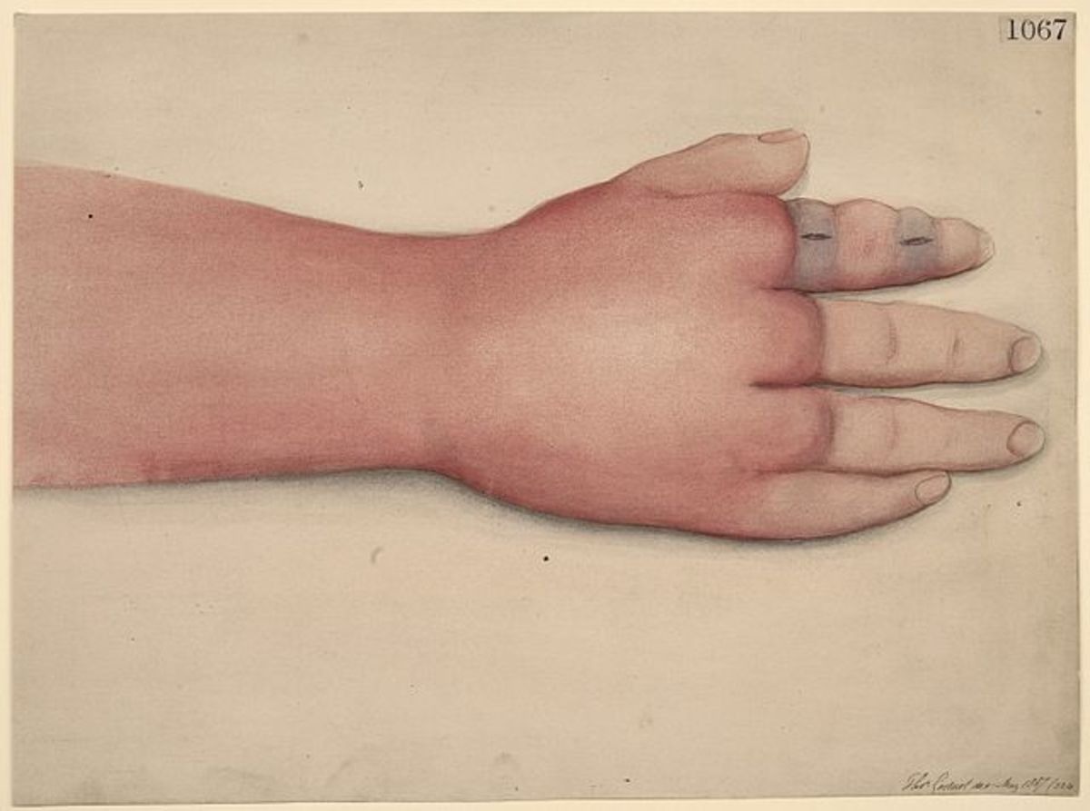 Skin Staph Infections with Pictures - HubPages