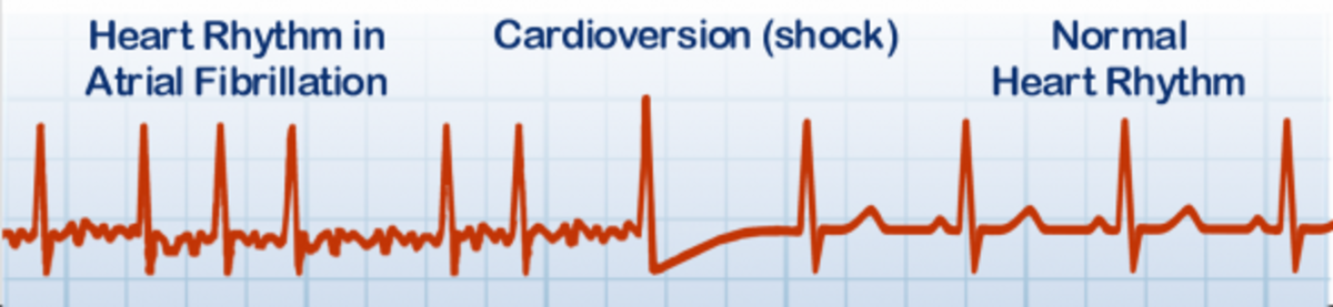 ♥ How to Beat Your Atrial Fibrillation ♥ An Introduction to A-Fib ...