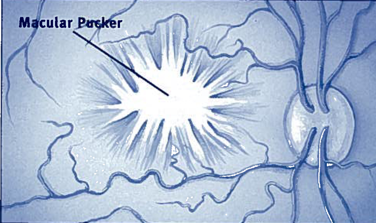 Macular Pucker - HubPages