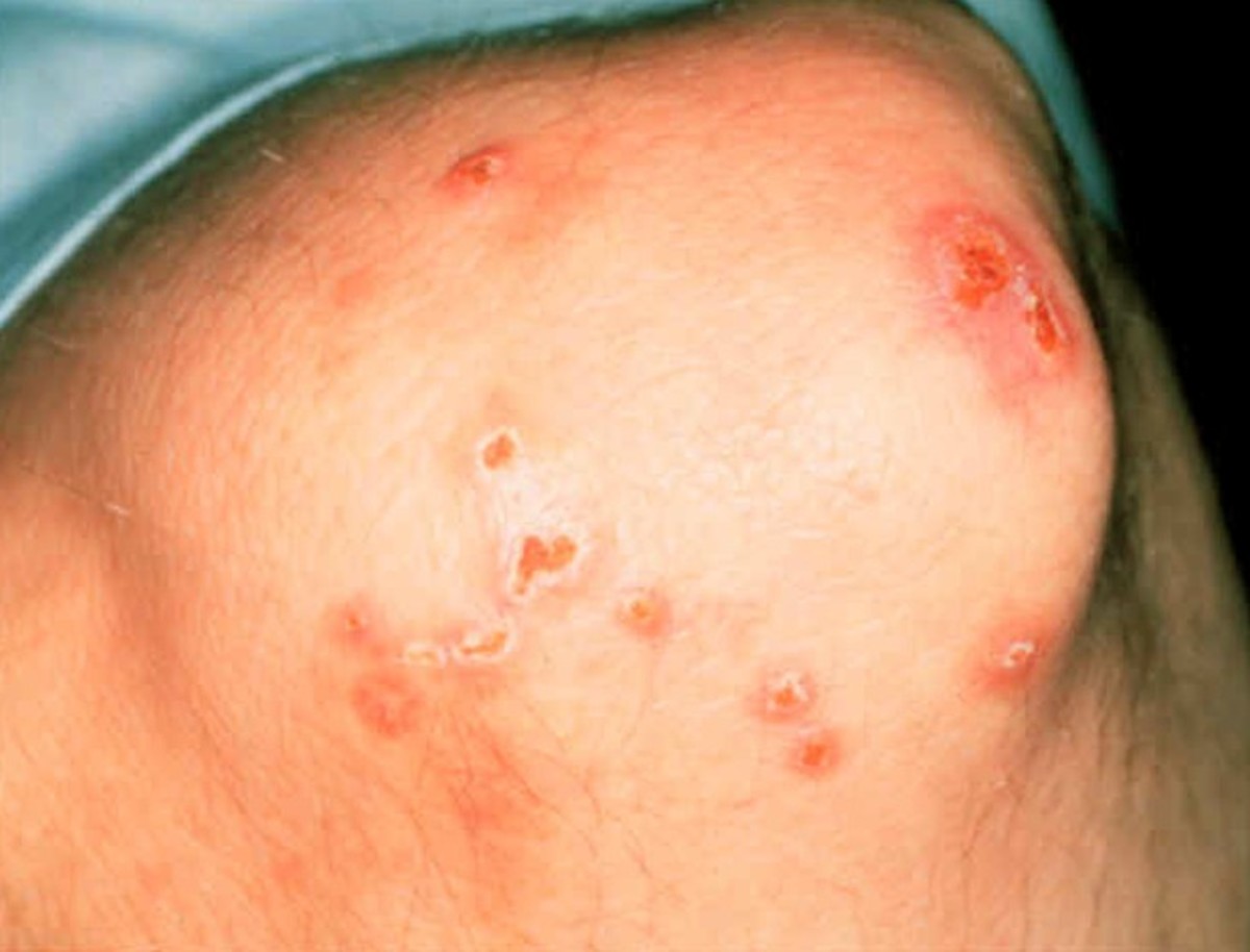 Pictures, Symptoms, Life Expectancy, and Causes of Churg Strauss ...