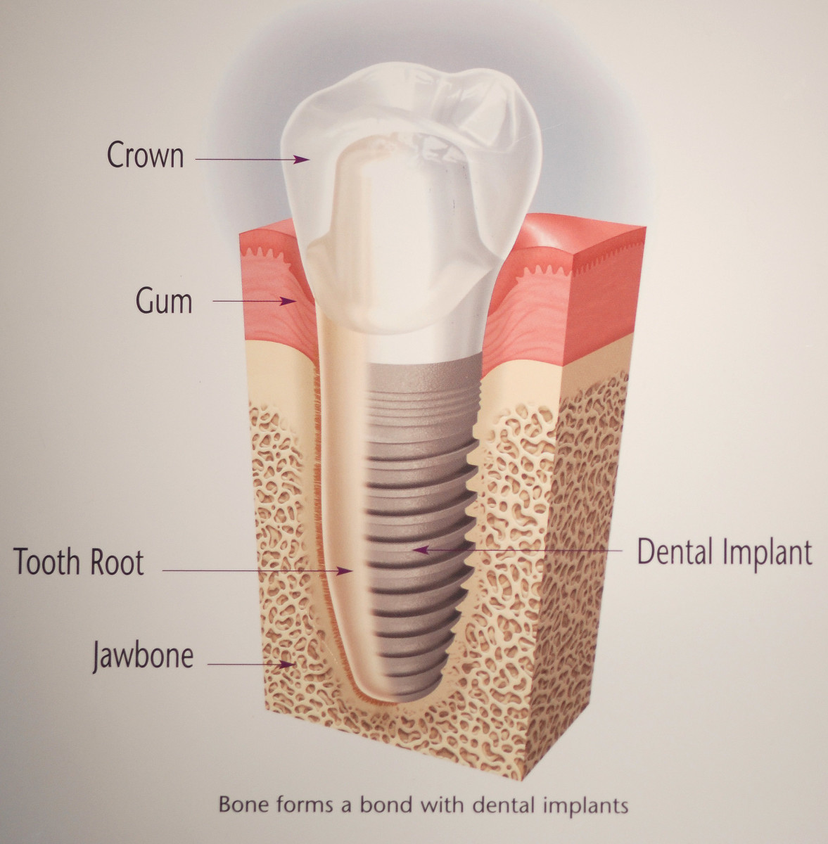What's the best way to replace a missing tooth or teeth? - HubPages