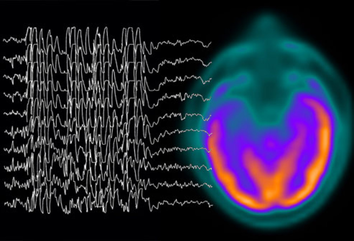 Electrical Impulse Control for Epileptic Patients - HubPages