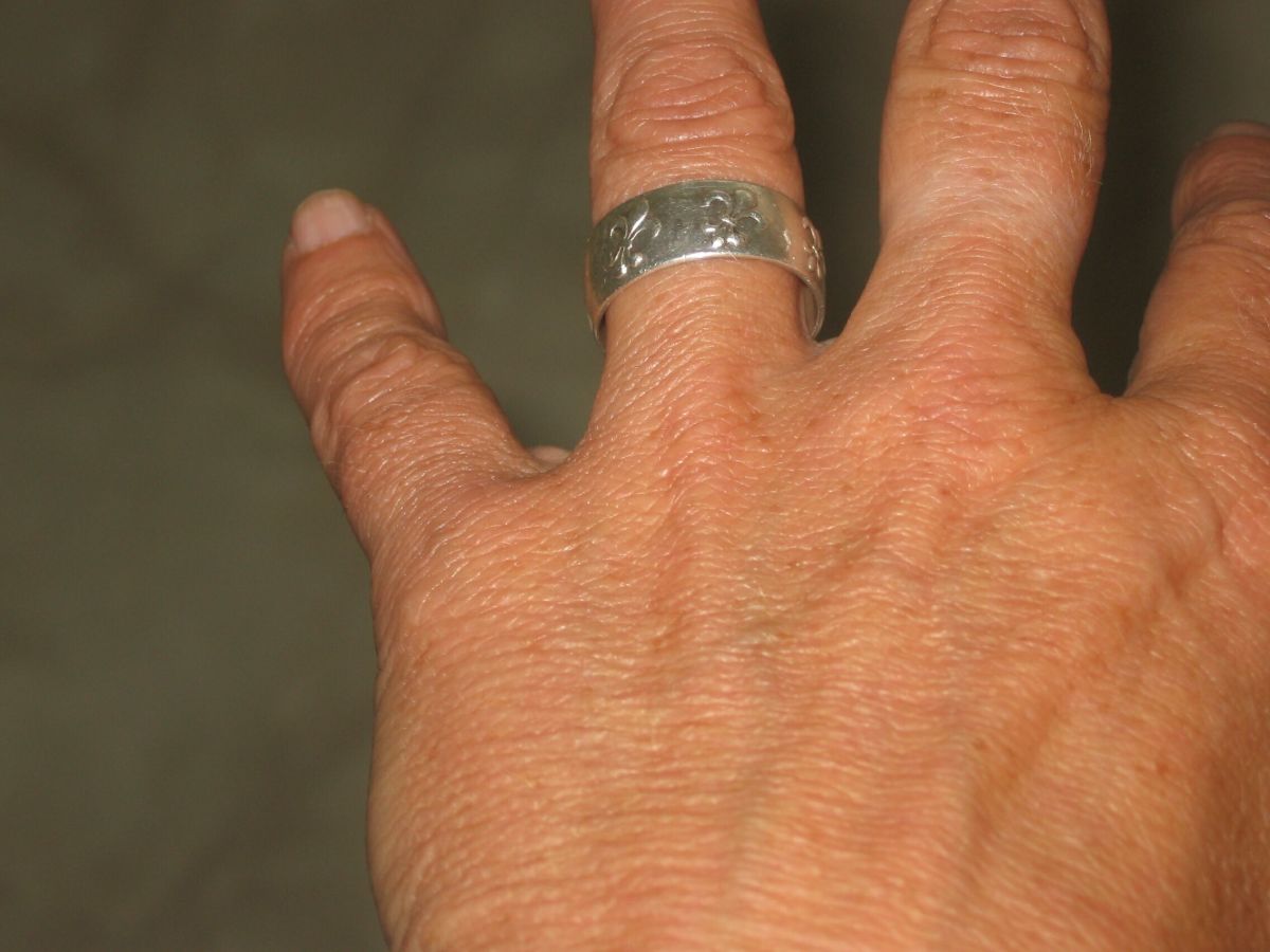 Finger Rings and Germs--What Organisms Lurk Under That Band? - HubPages