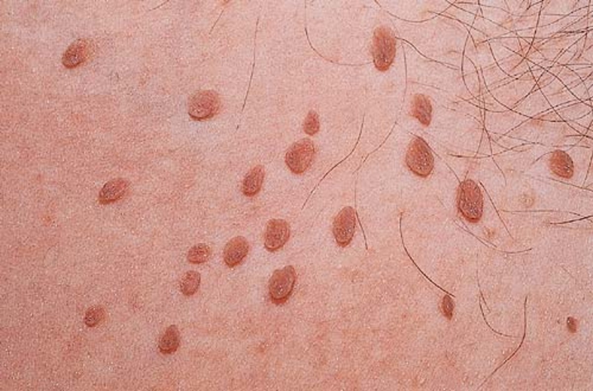 10 Easy Ways to Get Rid Of Skin Tags Naturally at Home - HubPages