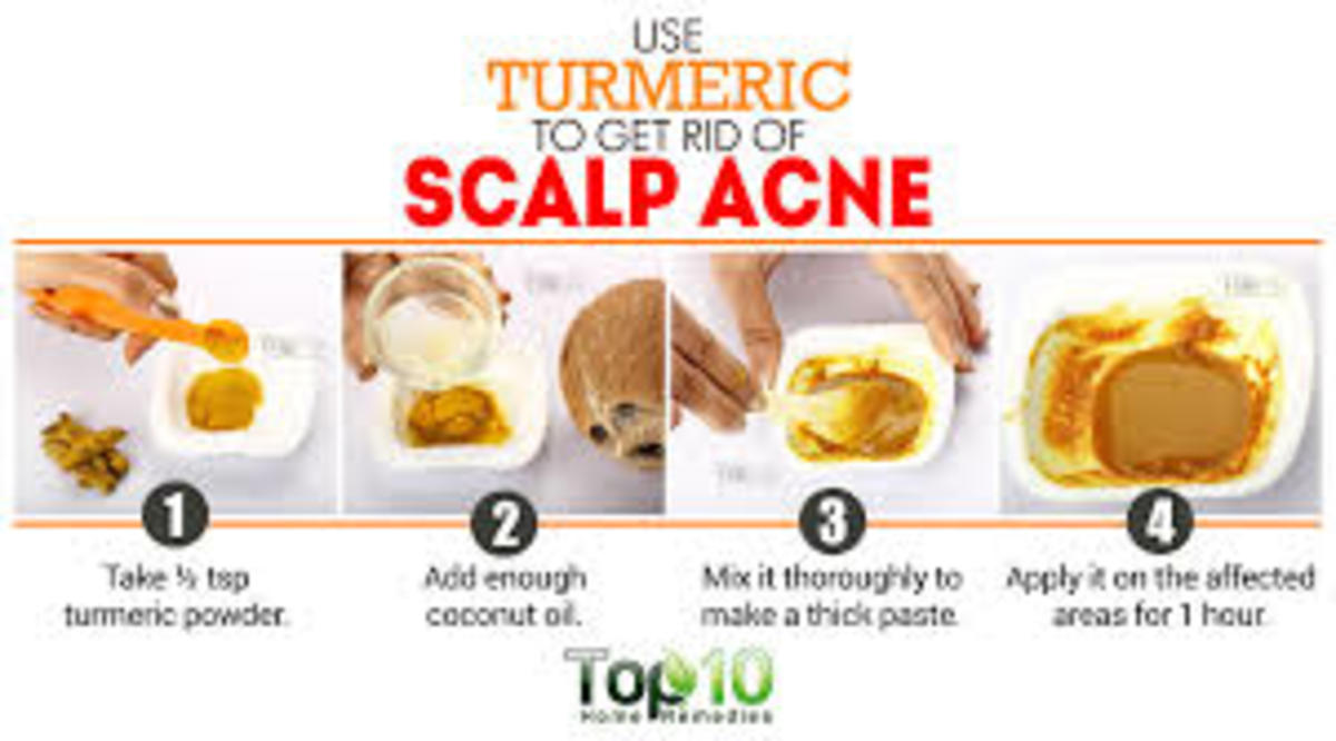 5 Home Remedies to Treat and Get Rid of Pimples - HubPages