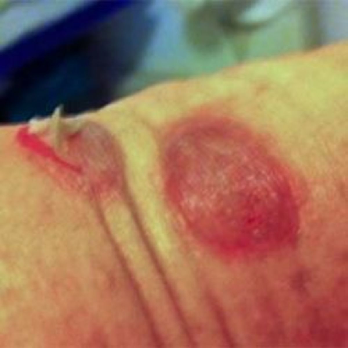 Bullous Pemphigoid | Blistering Skin Disease - HubPages