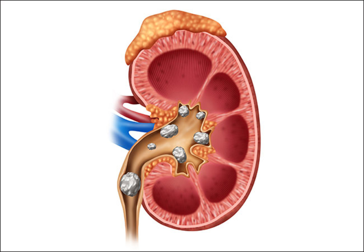 Signs And Symptoms Of Kidney Stones And Kidney Stone Pain - HubPages