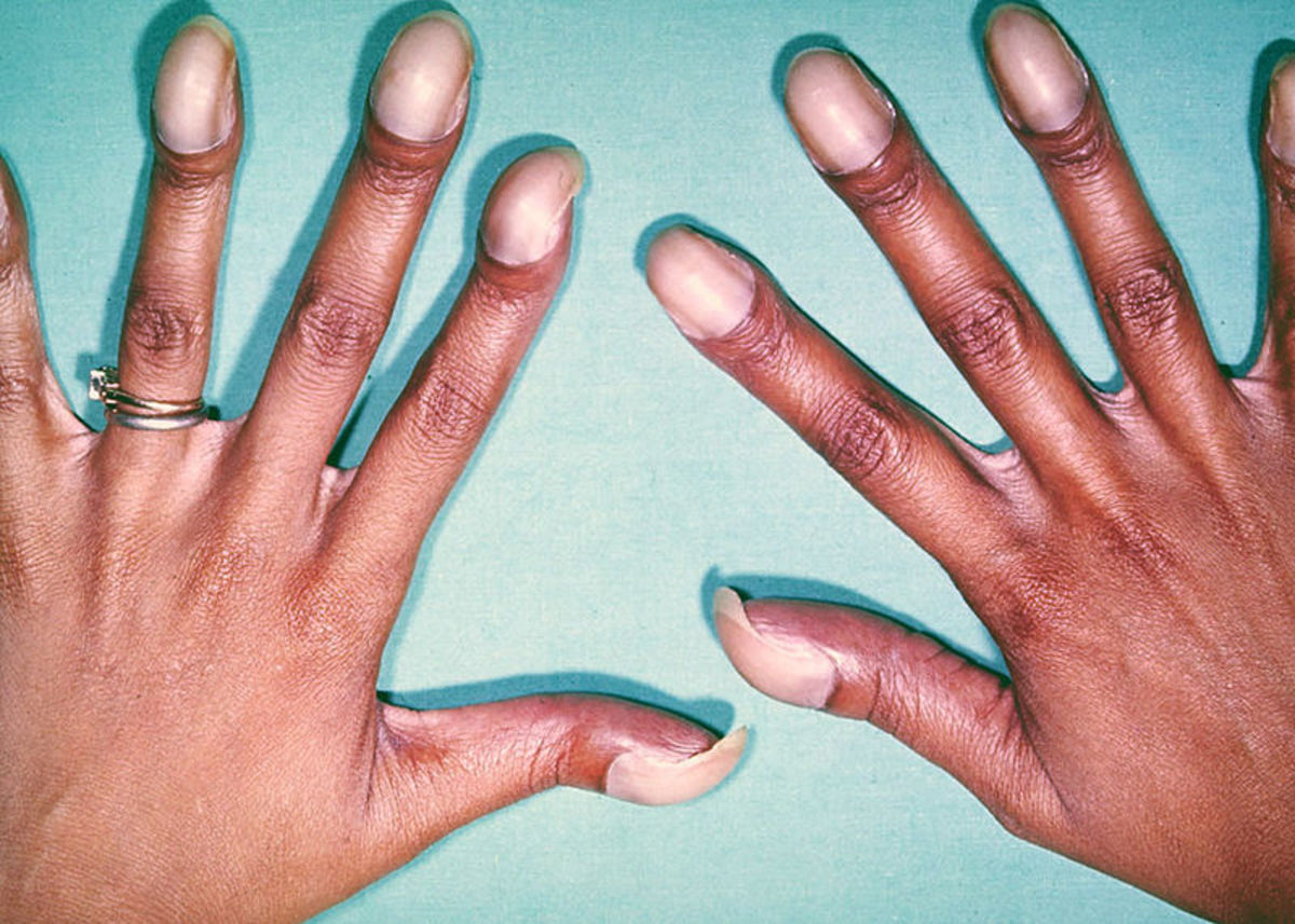 Nail Diseases, Disorders, and Conditions: Listen to What Your Nails ...