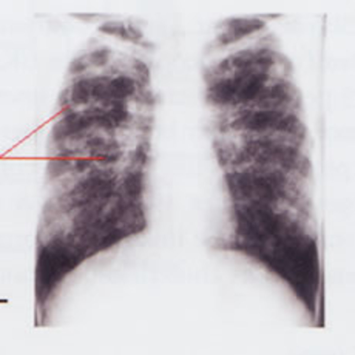 Reading The Chest X-Ray (Chest Radiography): Identifying A Normal Chest ...