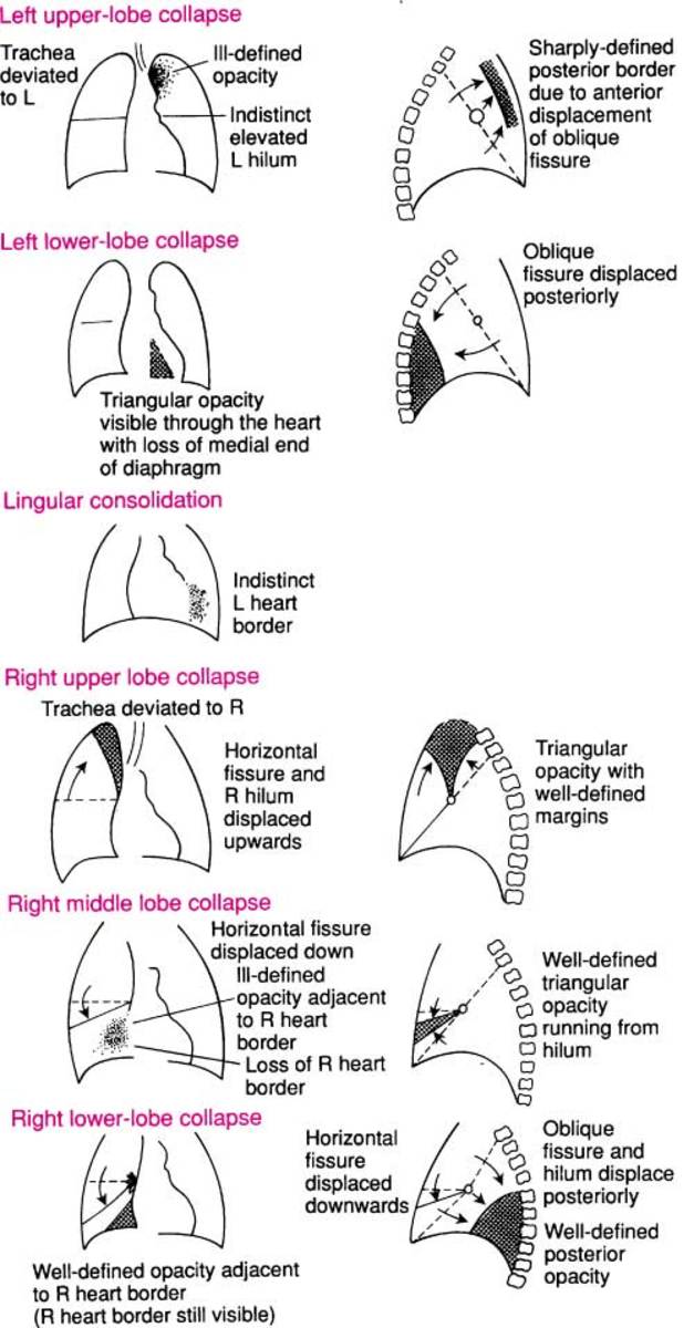 Reading The Chest X-Ray (Chest Radiography): Identifying A Normal Chest ...