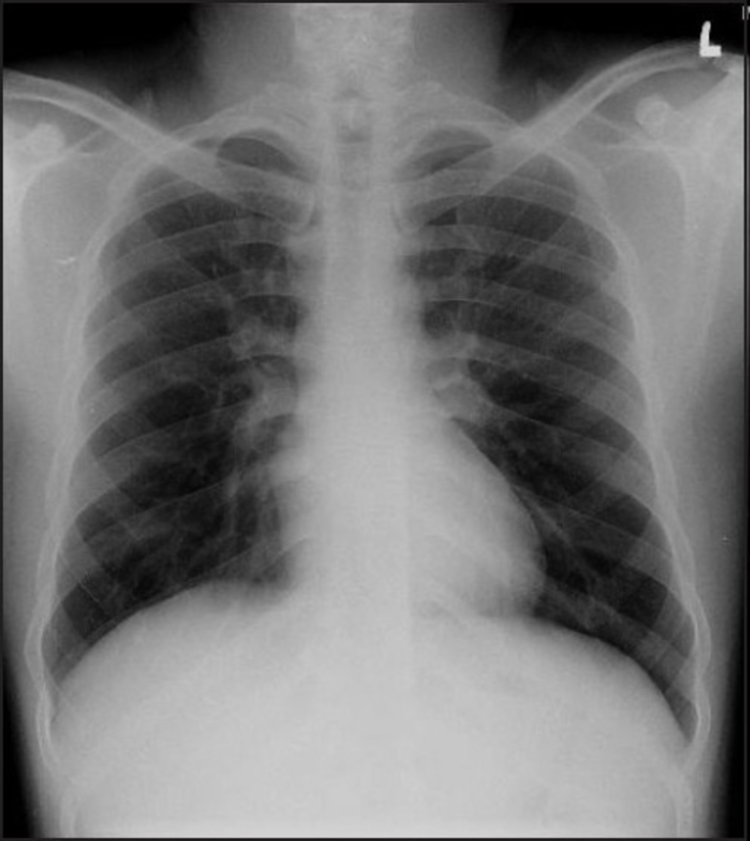 Reading The Chest X-Ray (Chest Radiography): Identifying A Normal Chest ...