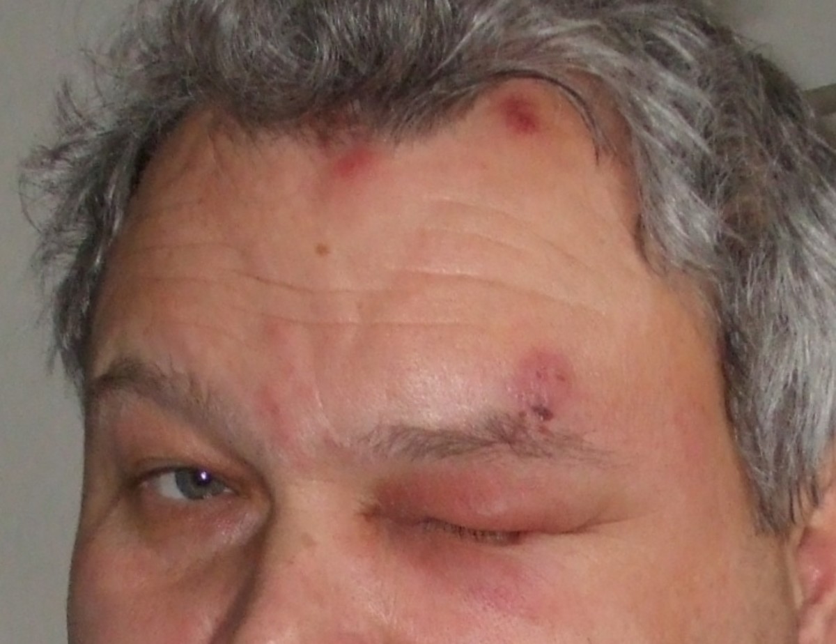 Do I Have Shingles Symptoms Causes And Natural Remedies For Shingles Herpes Zoster Virus