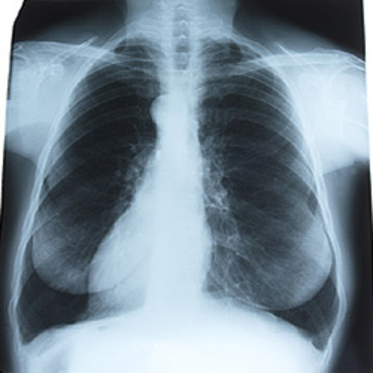 Pleurisy In Chest X-Ray: Various Radiographs To Show And Depict This ...