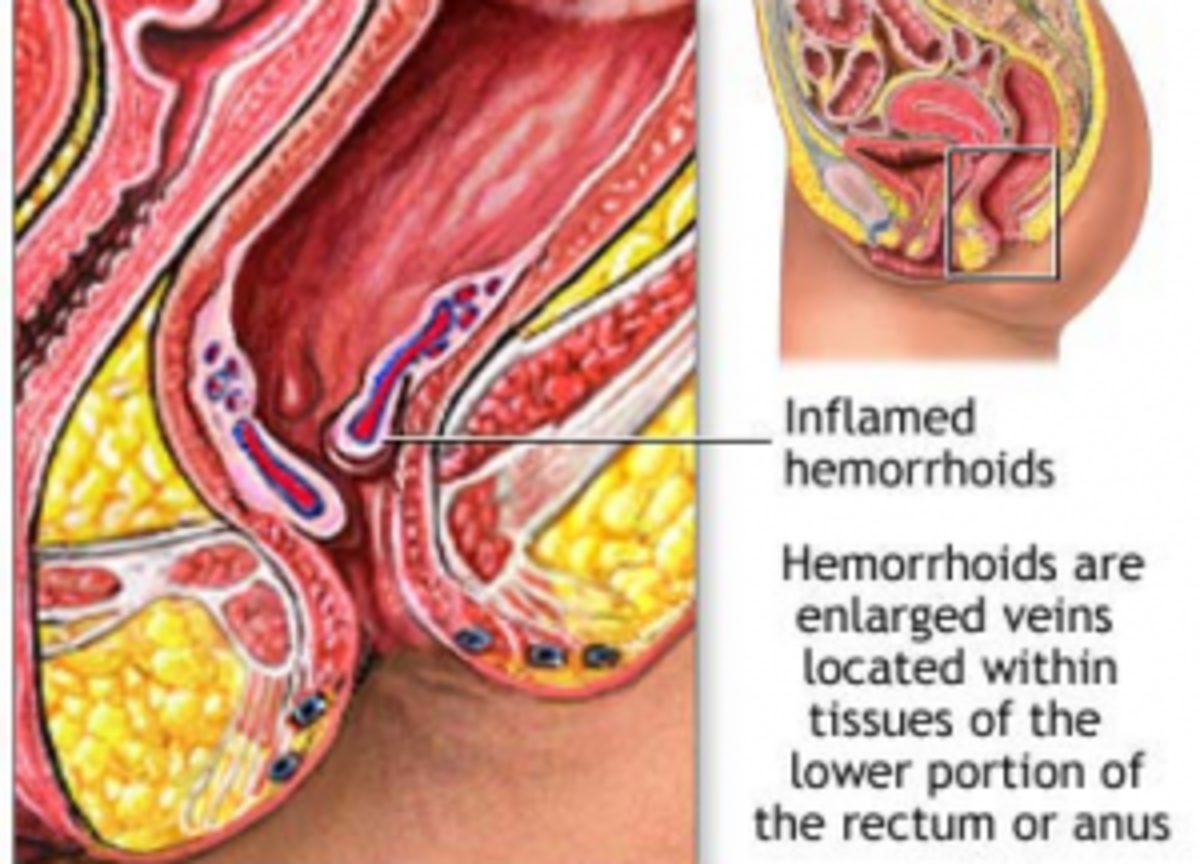 What Do Hemorrhoids Look Like Internal External HubPages What Do Hemorrhoids Look Like Internal External HubPages