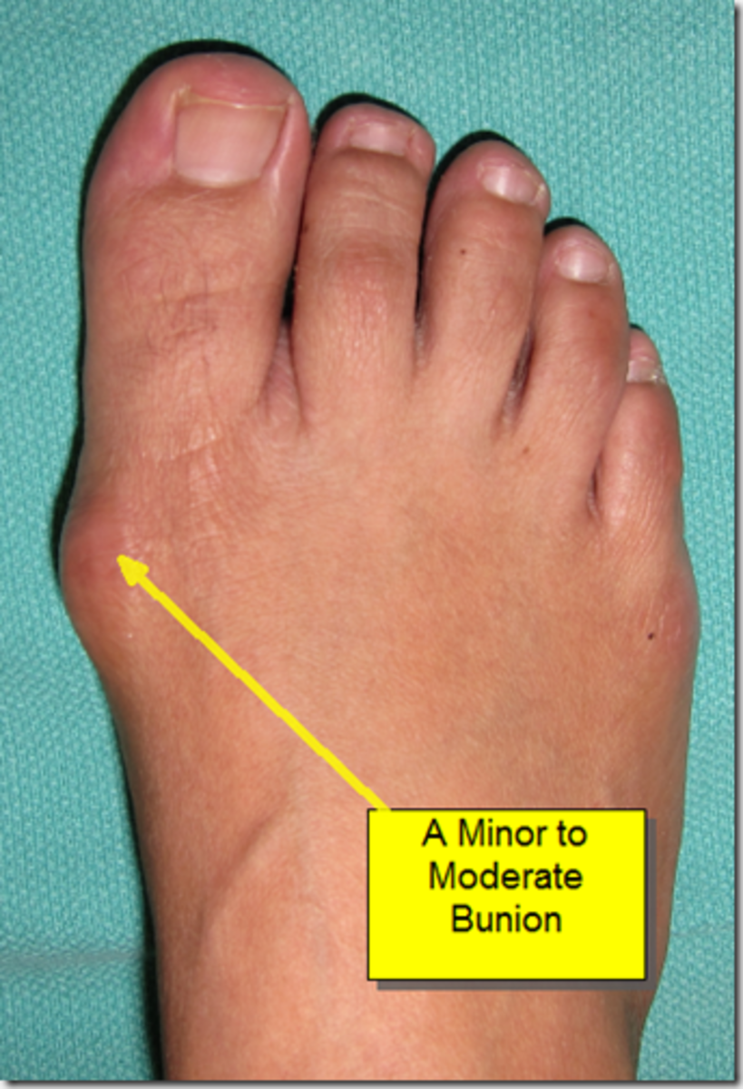 Bunion Operation - Surgery, Special Boots, Pros and Cons, Advice ...