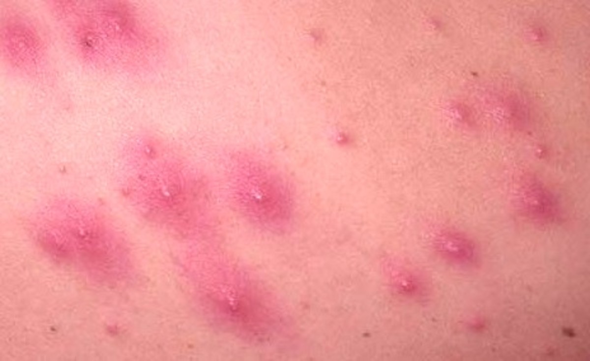 Folliculitis – Pictures, Symptoms, Causes, Treatment - HubPages