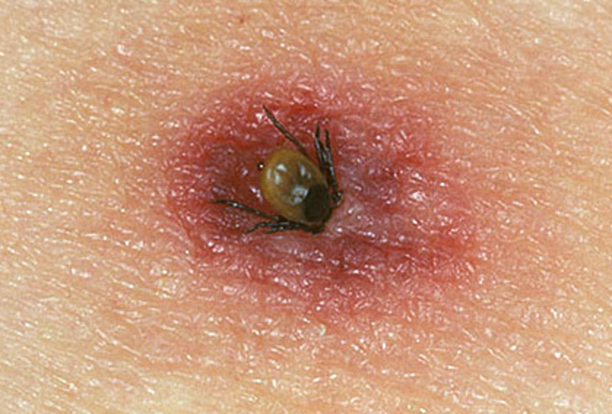 Tick Bites On Humans Images Symptoms Causes Treatment HubPages