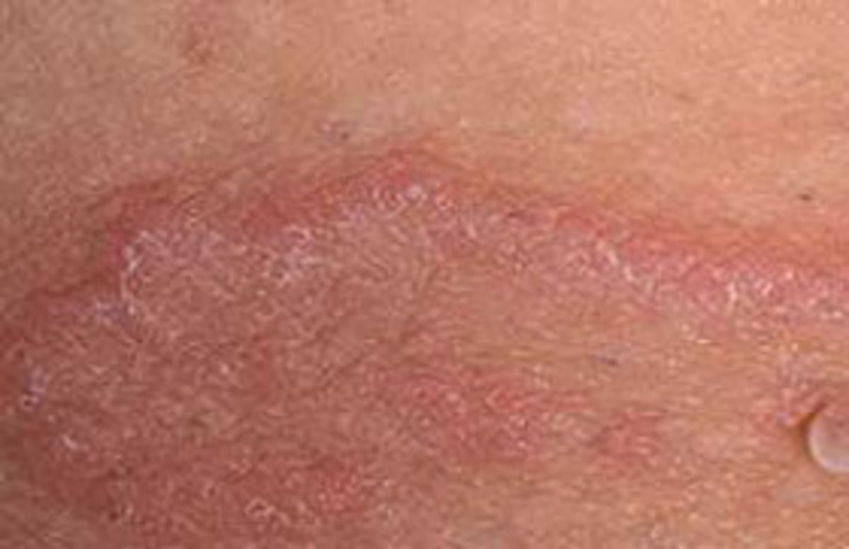Jock Itch Blisters Jock Itch Blisters