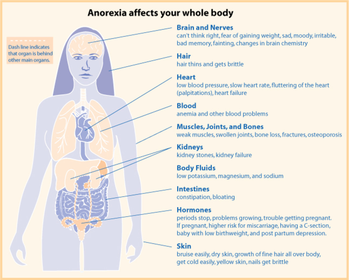 Definition of Anorexia - HubPages