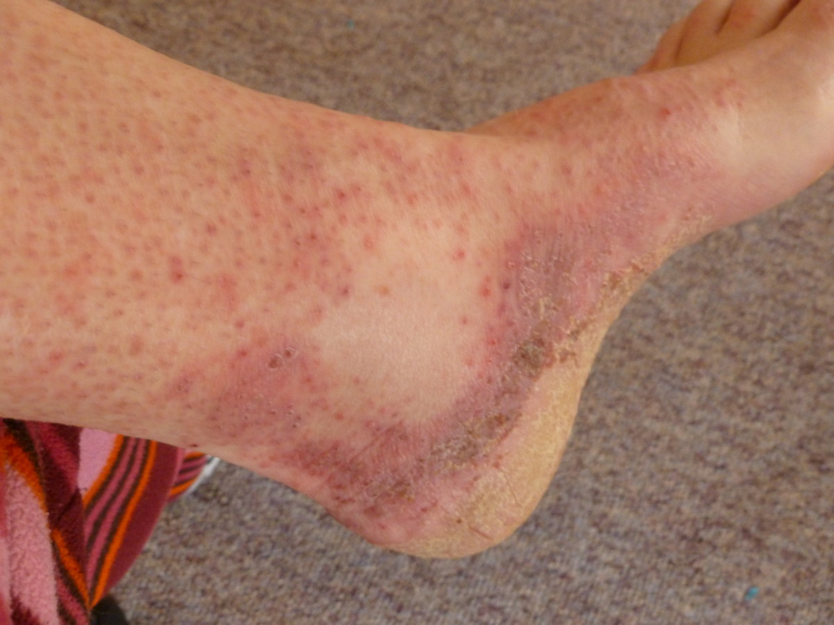 Allergies: My Environmental Reaction - HubPages