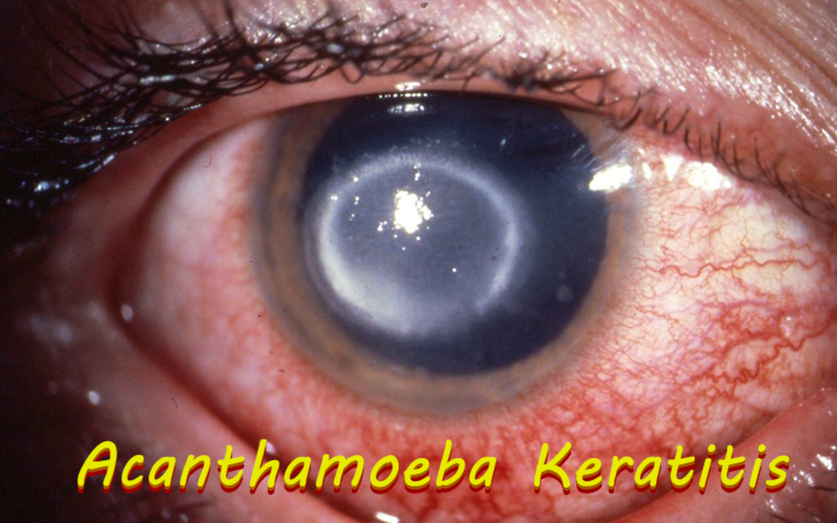 Top 10 Terrifying Parasites That Could Be Inside You - HubPages