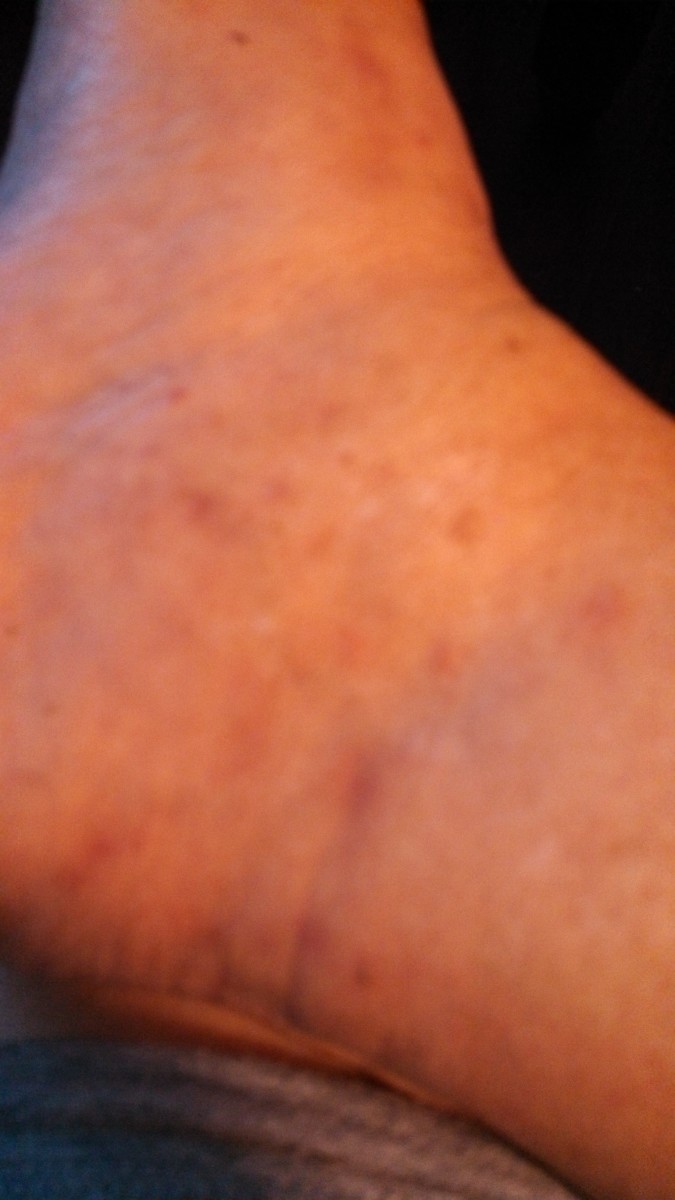 Fire Ants ~~ the Good, the Bad, and the Awful - HubPages