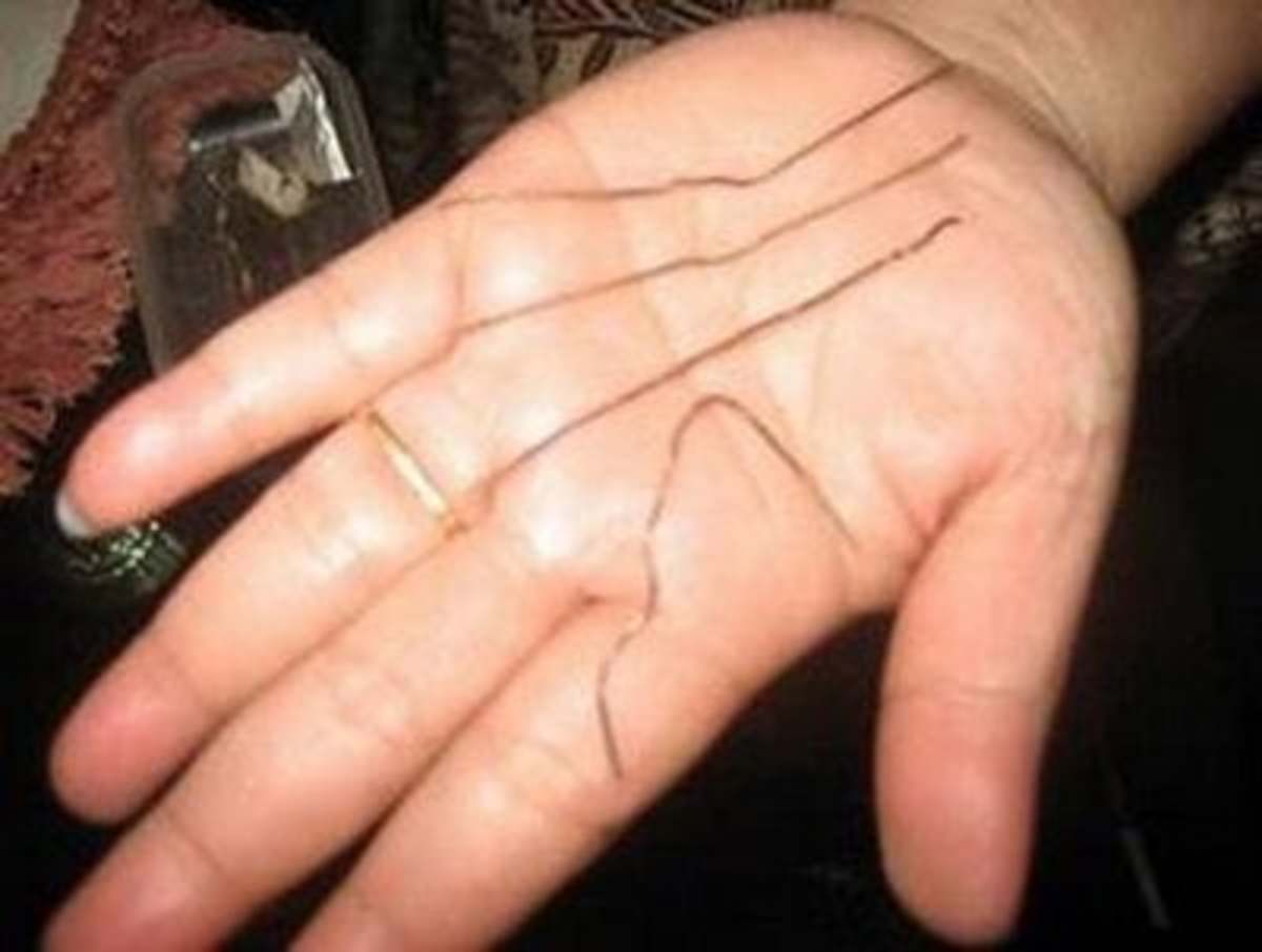 The Strange Case of a Woman with Wires Emerging from Her Stomach - HubPages