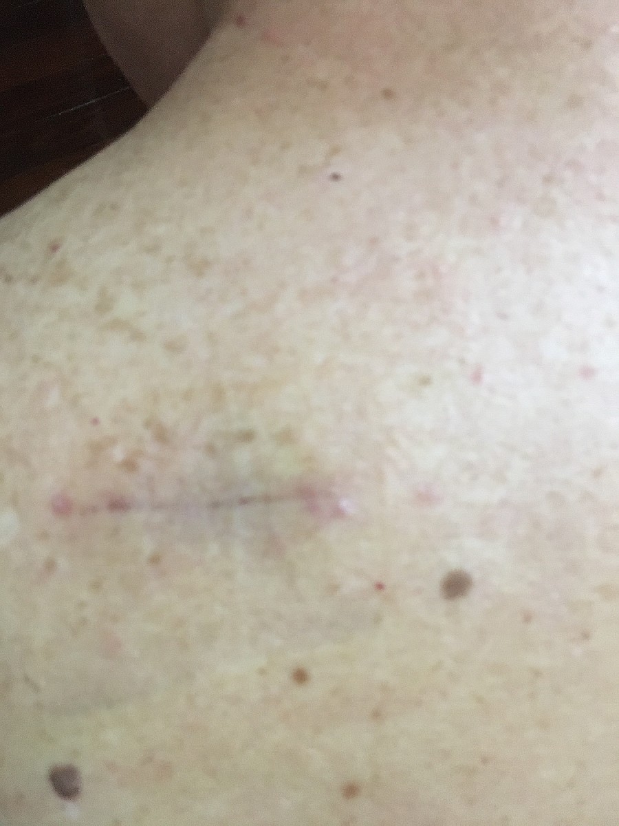Treatment for My Sebaceous Cyst - HubPages