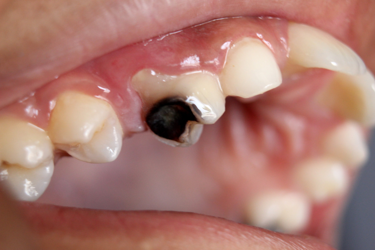 Are Cavities Contagious? How Bacteria Spreads and What to Do - HubPages