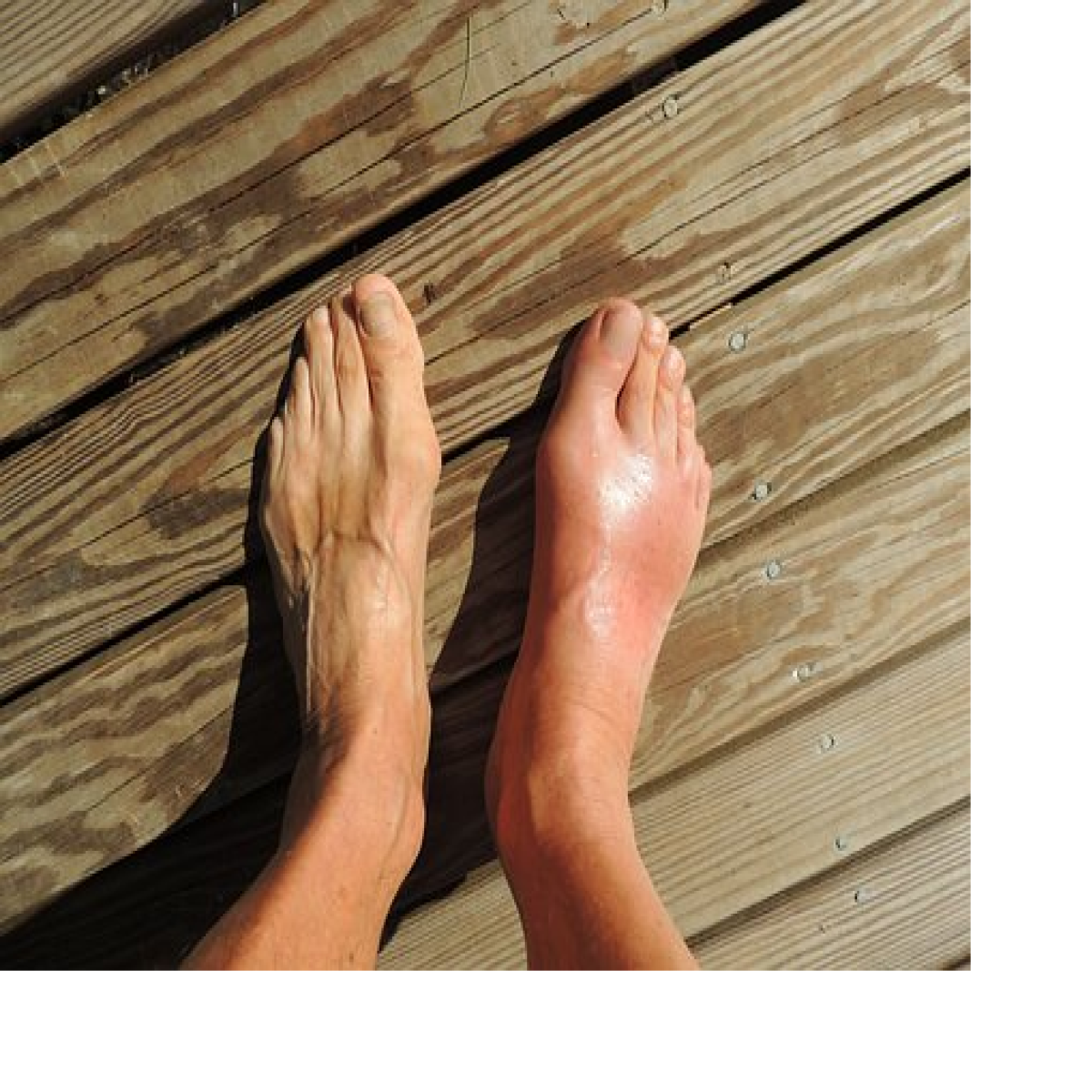 The Early Onset of 5 Different Types of Arthritis. - HubPages