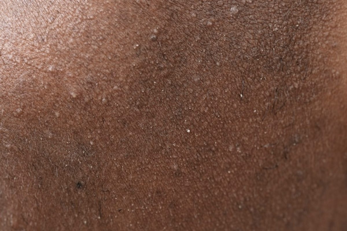 The 3 Main Challenges of Having Hyperpigmentation - HubPages