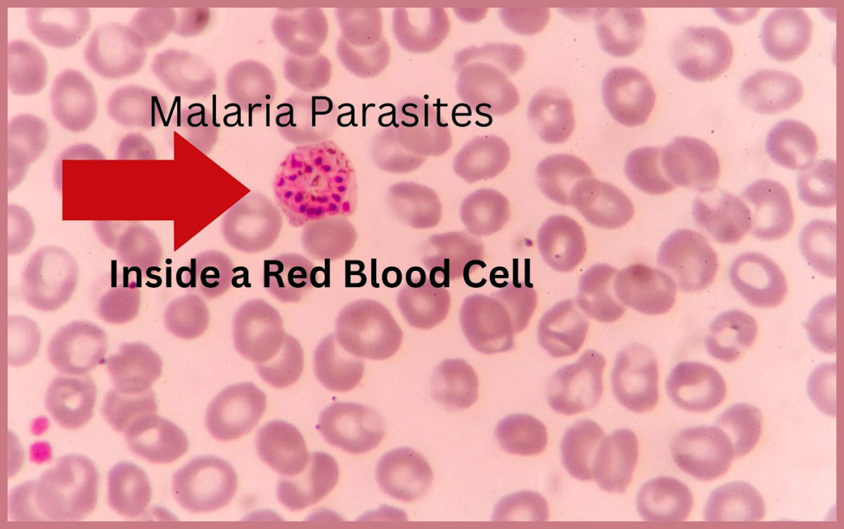Sickle Cell Disease and Malaria - HubPages