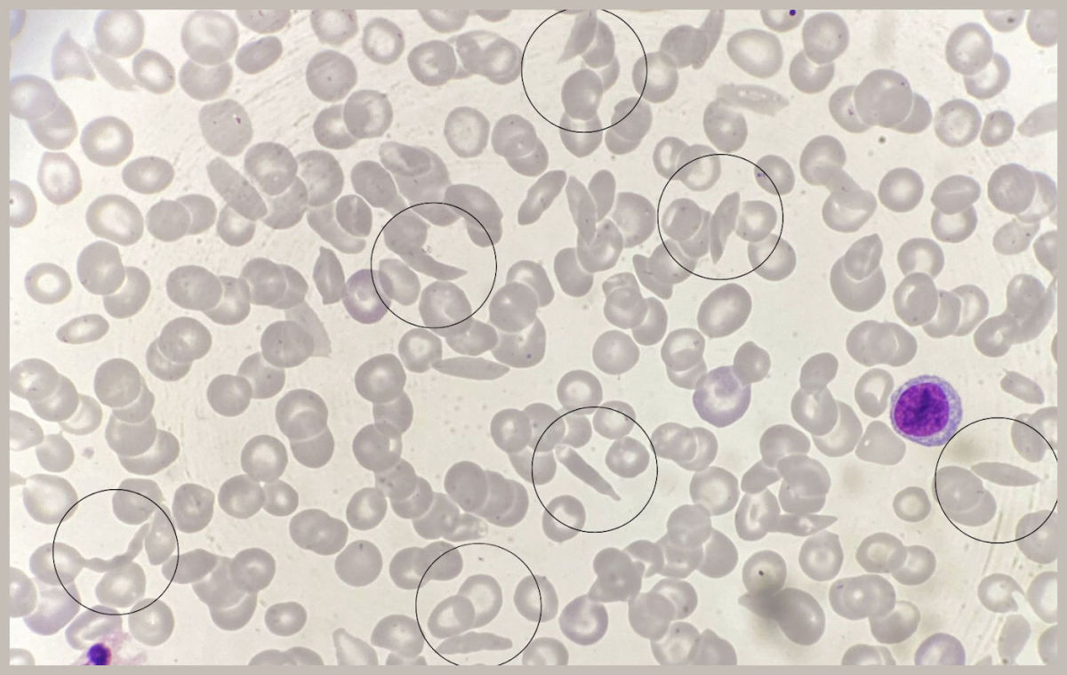 Sickle Cell Disease and Malaria - HubPages