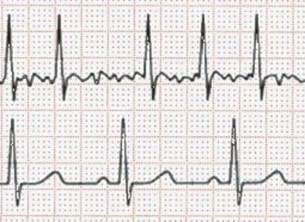 How to Read EKGs – Identifying Atrial Fibrillation - HubPages