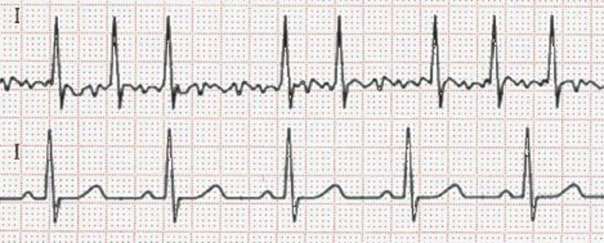 How to Read EKGs – Identifying Atrial Fibrillation - HubPages